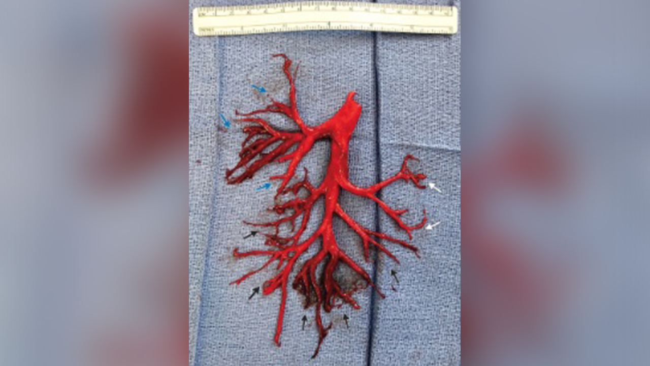 Man coughs up blood clot shaped like lung tree, doctors ‘astonished ...