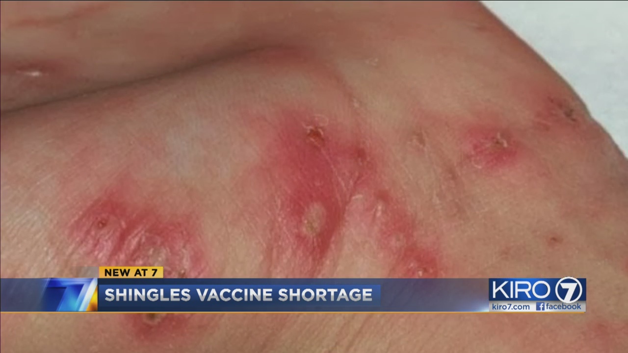 New shingles vaccine very effective, hard to find – KIRO 7 News Seattle