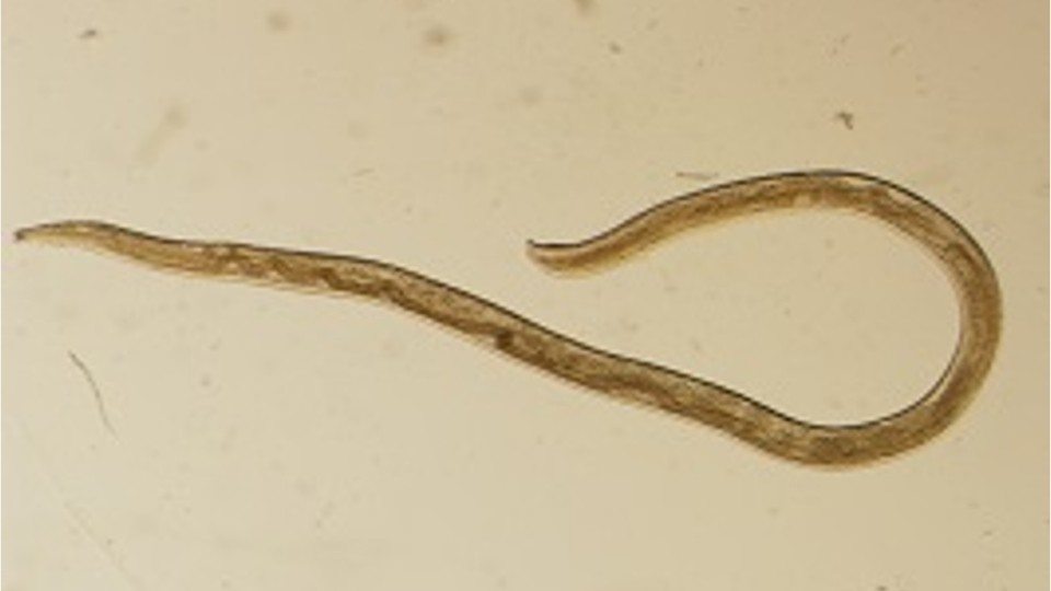 Woman has 14 tiny, wriggling worms pulled from her eye