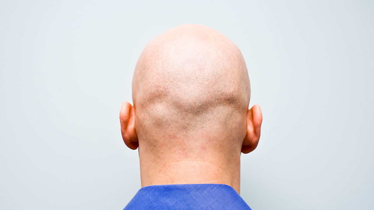 Study finds bald men are perceived as more attractive, confident and ...