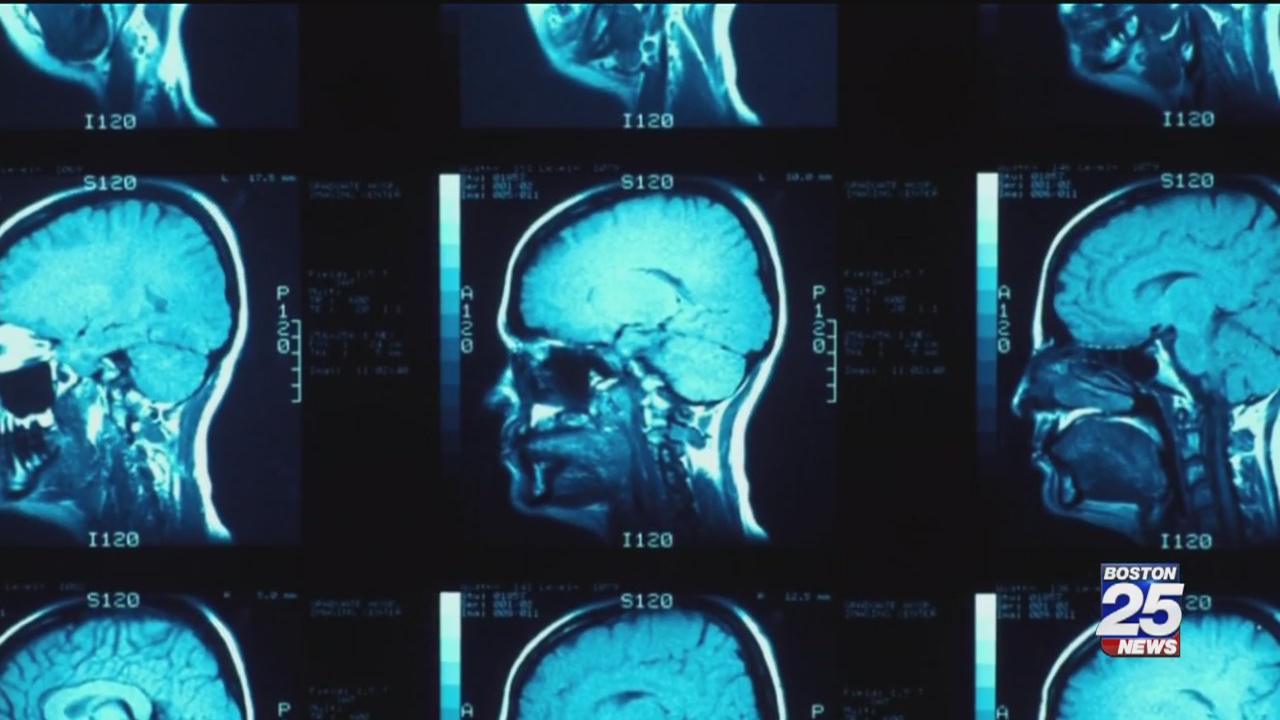 BU researchers say CTE diagnosis may be possible before death
