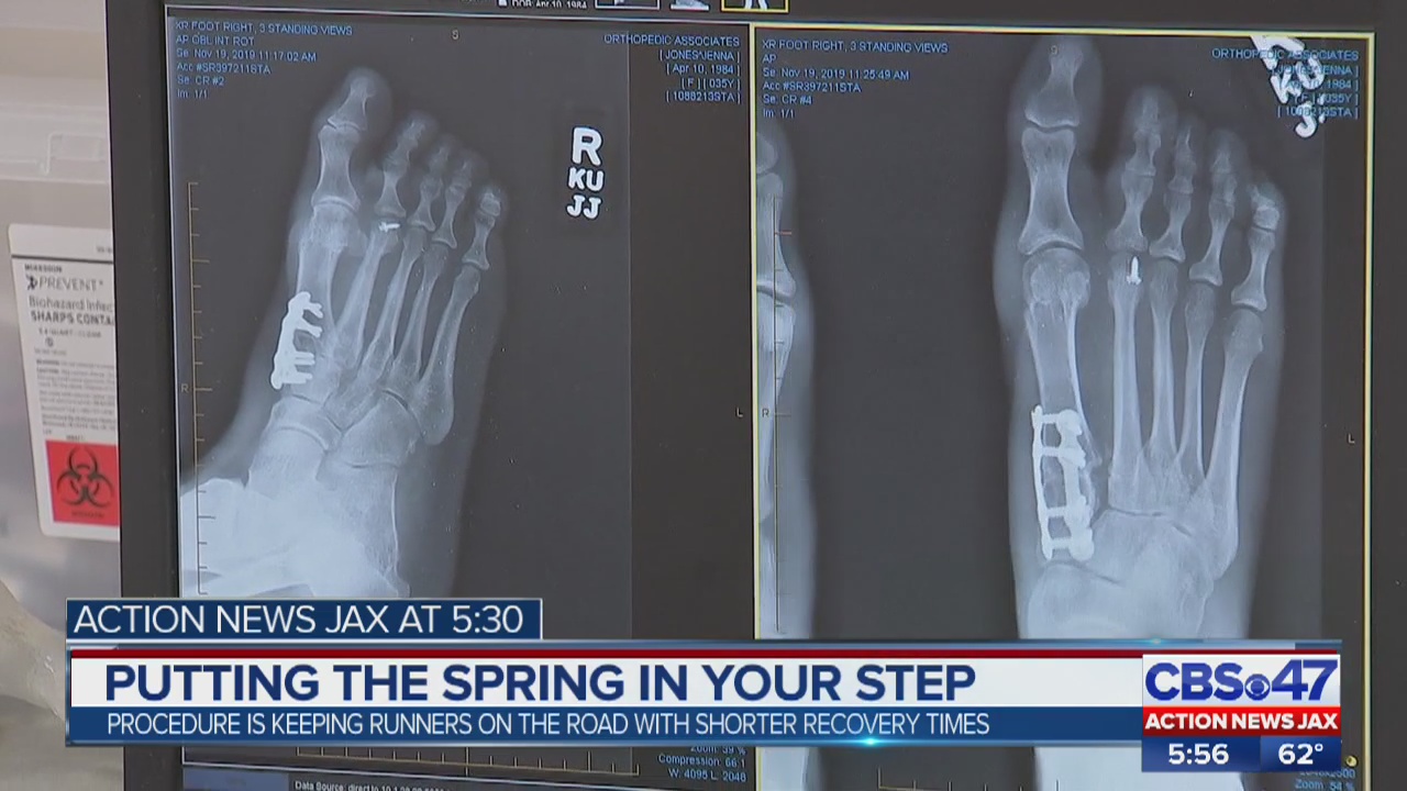 Major breakthrough for a common bone deformity